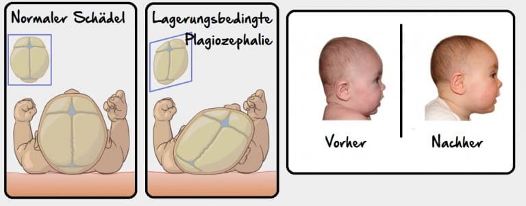 Osteopathie gegen flachen Hinterkopf beim Baby - Physio Jorge Bazan